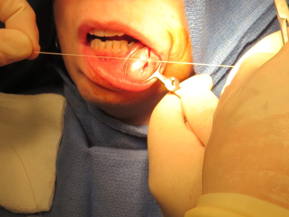 Lip Biopsy for Sjogren's Syndrome (Minor Salivary Gland Biopsy) Using ...