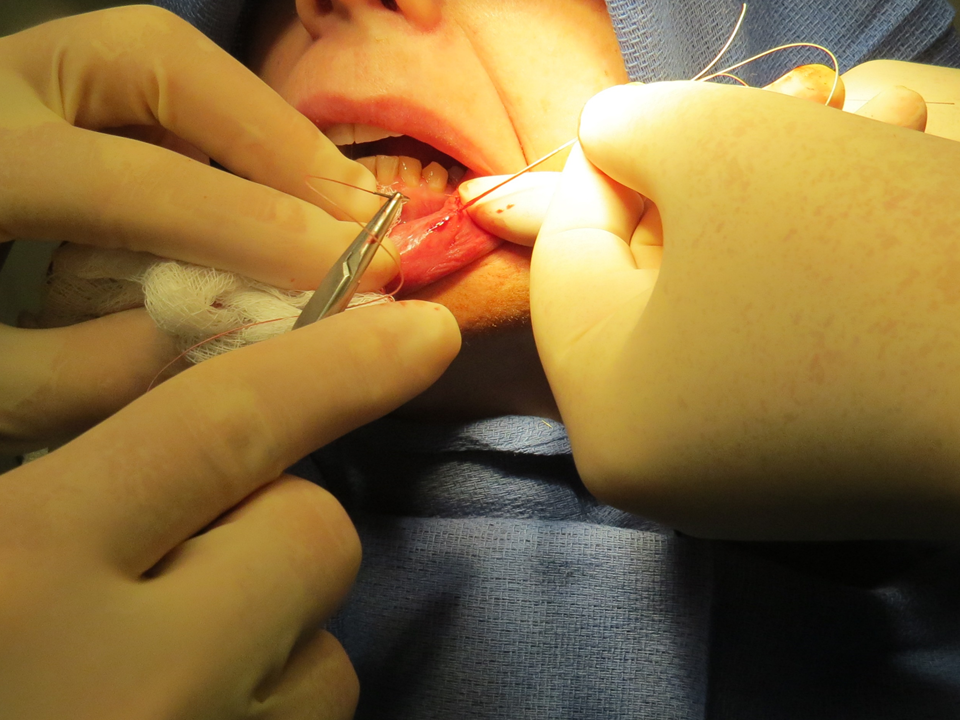 Lip Biopsy for Sjogren's Syndrome (Minor Salivary Gland Biopsy) Using ...