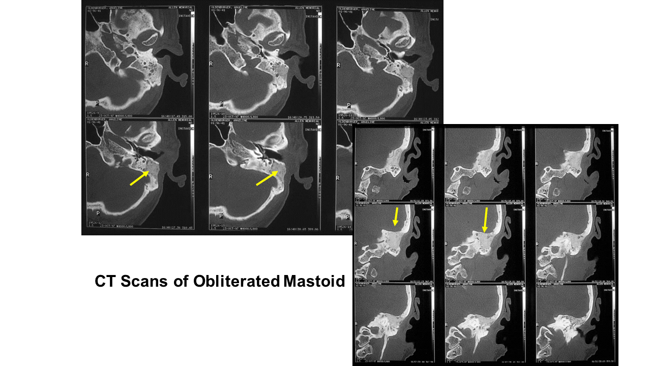 Canal Wall Reconstruction (Mastoidectomy) | Iowa Head and Neck ...