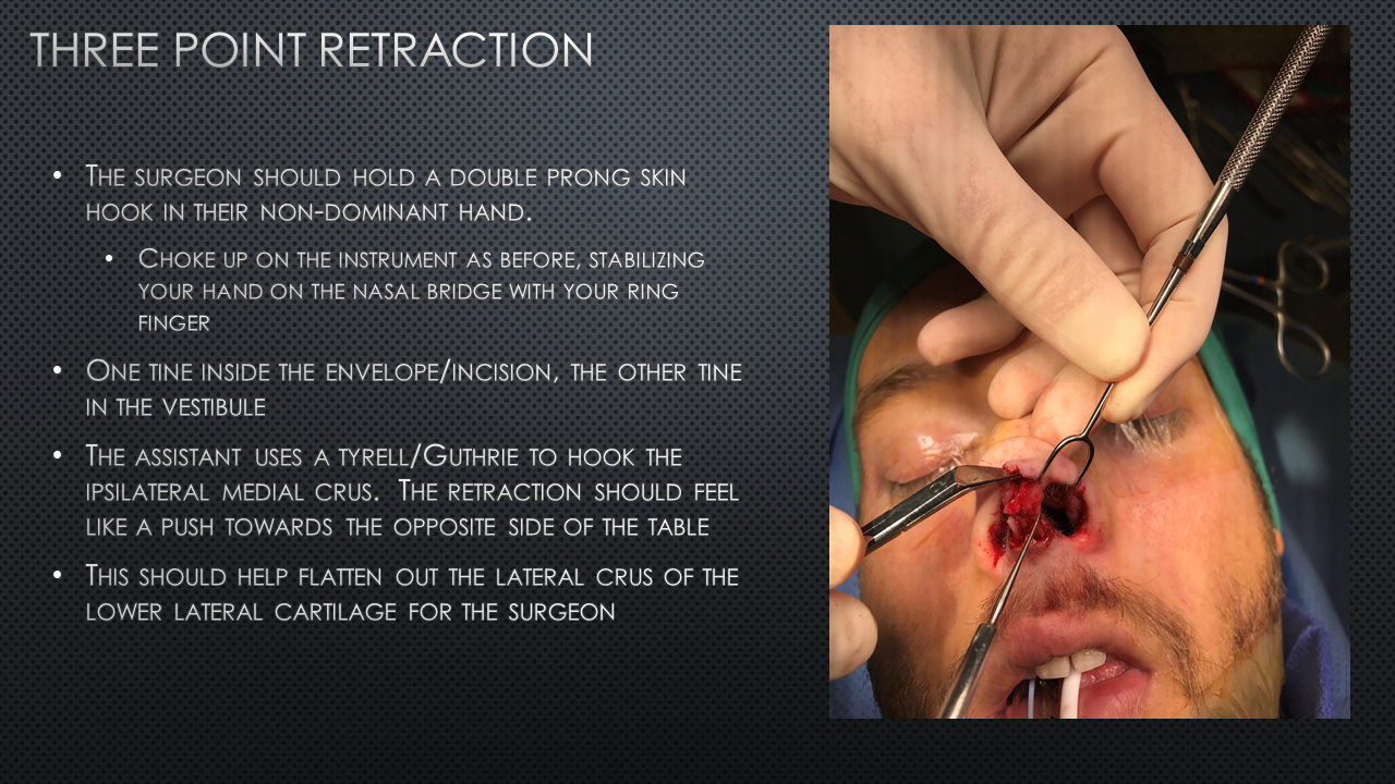 Open Septorhinoplasty - Surgical Demonstration (Rhinoplasty) | Iowa ...