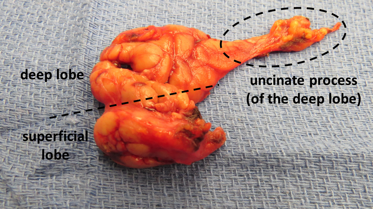 Submandibular Gland Anatomy: The Uncinate Process of the Deep Lobe ...