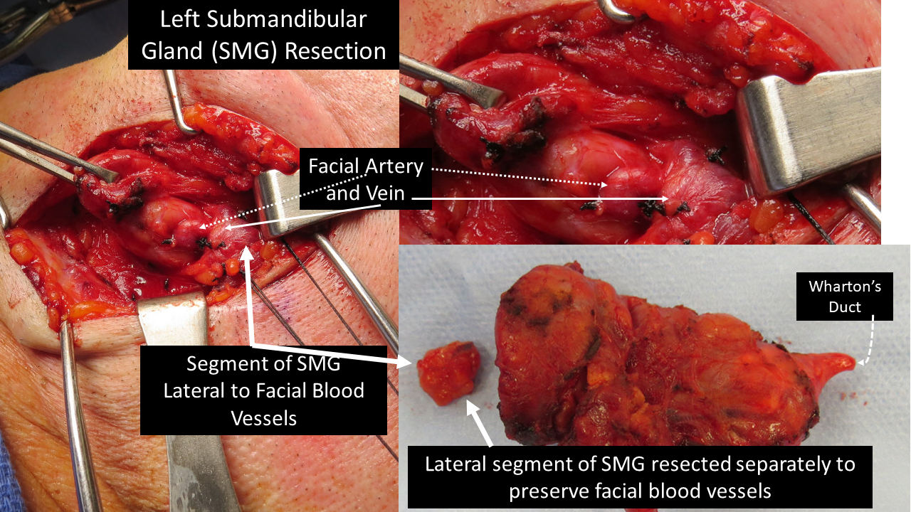 Submandibular Gland Anatomy: Vascular Supply - Ultrasound Imaging with ...