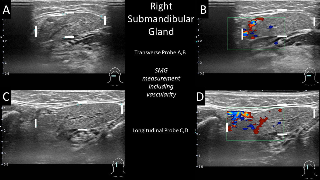 Submandibular Gland Anatomy: Vascular Supply - Ultrasound Imaging with ...