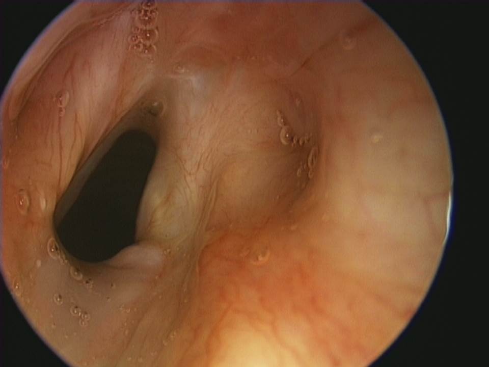 Anterior Glottic Web | Iowa Head and Neck Protocols - Carver College of ...