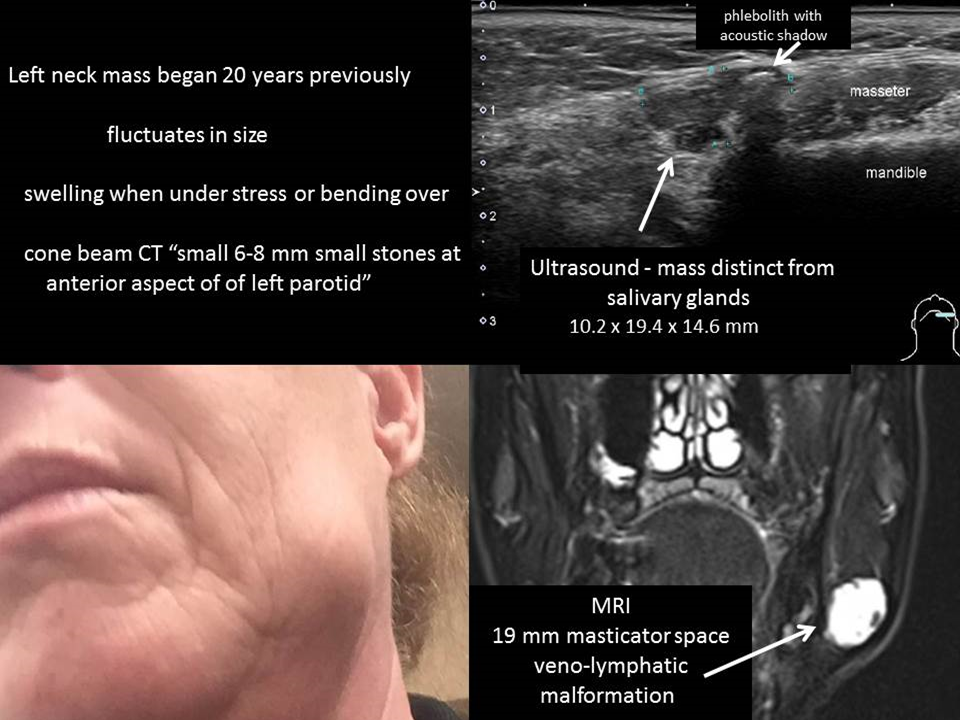 Ultrasound Appearance of Facial Venolymphatic Malformation with ...