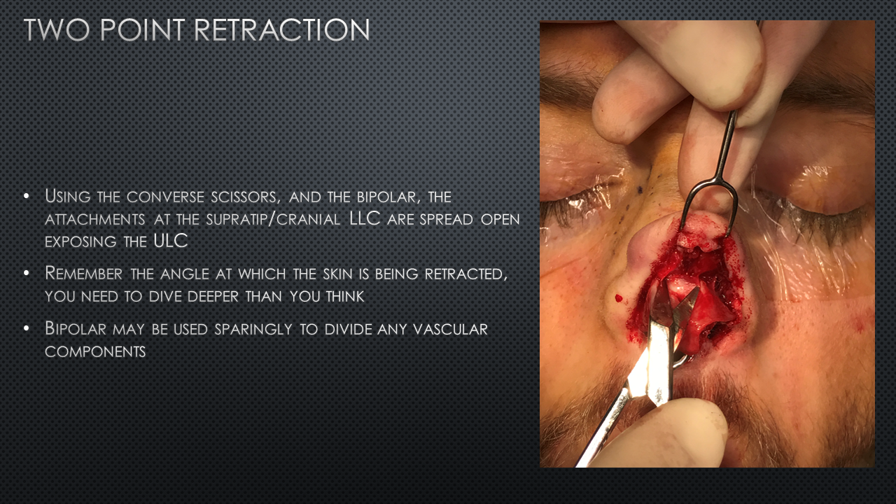 Open Septorhinoplasty - Surgical Demonstration (Rhinoplasty) | Iowa ...