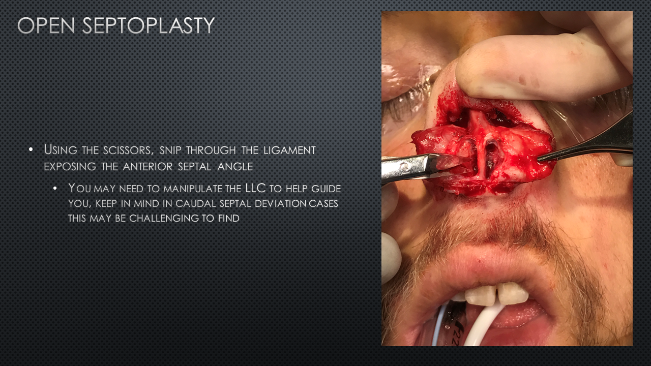 Open Septorhinoplasty - Surgical Demonstration (Rhinoplasty) | Iowa ...