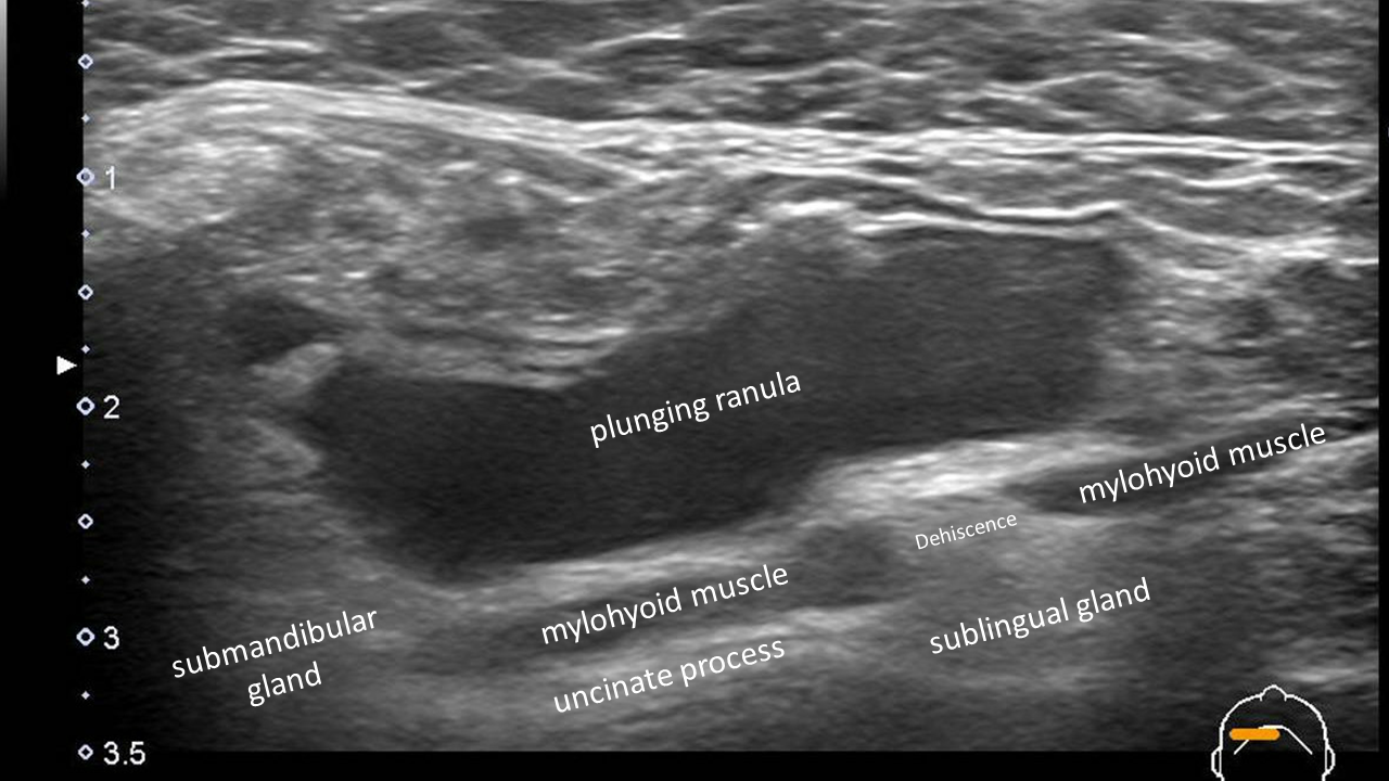 Submandibular Gland Anatomy: The Uncinate Process of the Deep Lobe ...