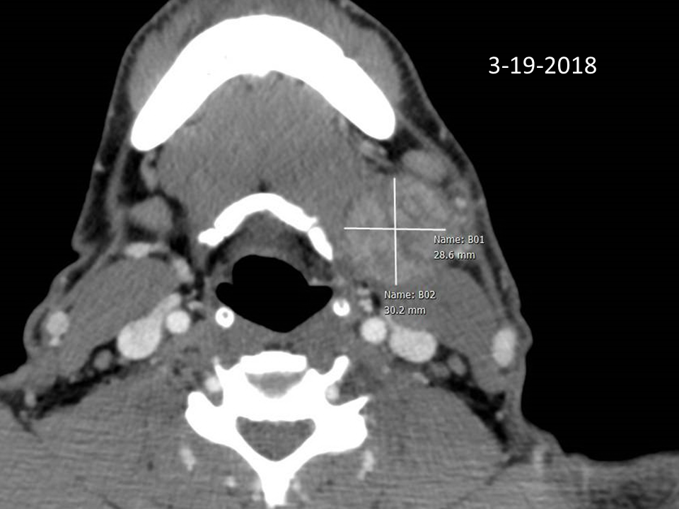 Submandibular Abscess from Stone | Iowa Head and Neck Protocols ...