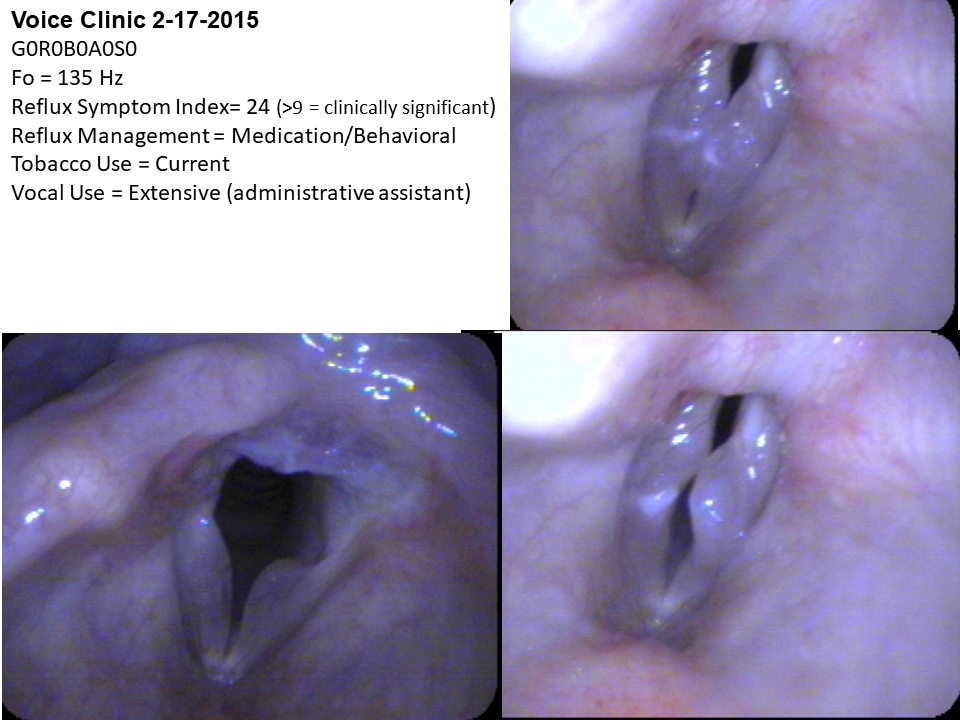 Polypoid Corditis (Reinke's Edema) Progression Over A Decade | Iowa ...