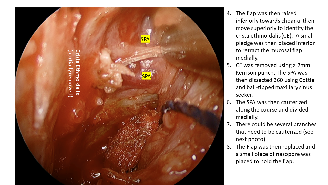 Nosebleed - Epistaxis: Sphenopalatine Artery (SPA) Ligation ...