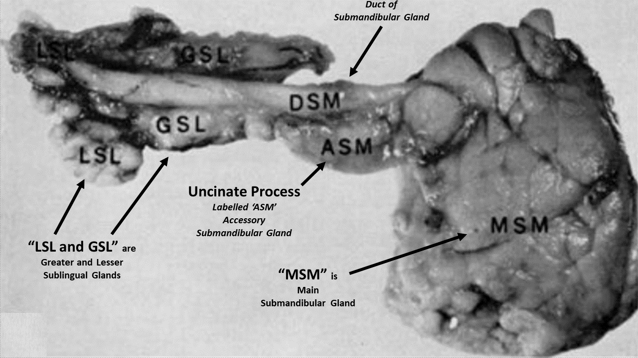 Submandibular Gland Anatomy: The Uncinate Process of the Deep Lobe ...