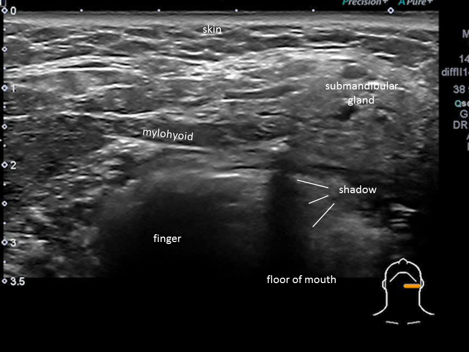 Sonopalpation (Ultrasound) Submandibular Stone | Iowa Head and Neck ...