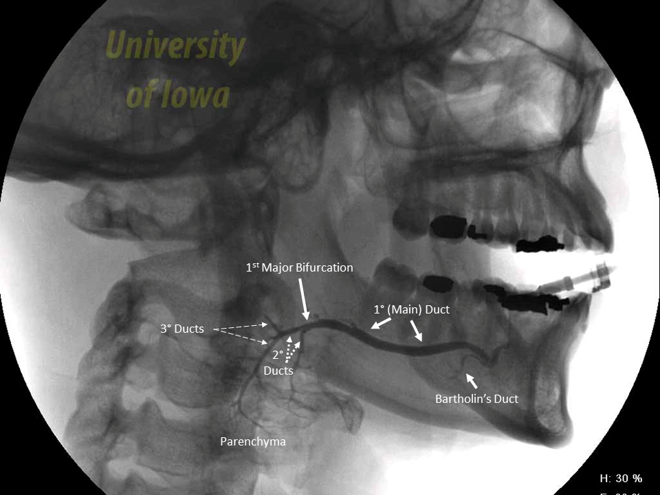 Anatomy of Submandibular Gland and Duct | Iowa Head and Neck Protocols ...