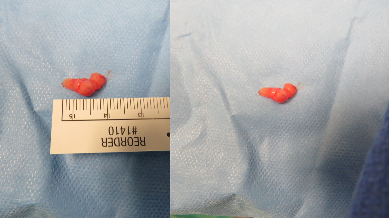 Lower Lip Bump (Mucocele versus Mucus Retention Cyst) Minor Salivary ...