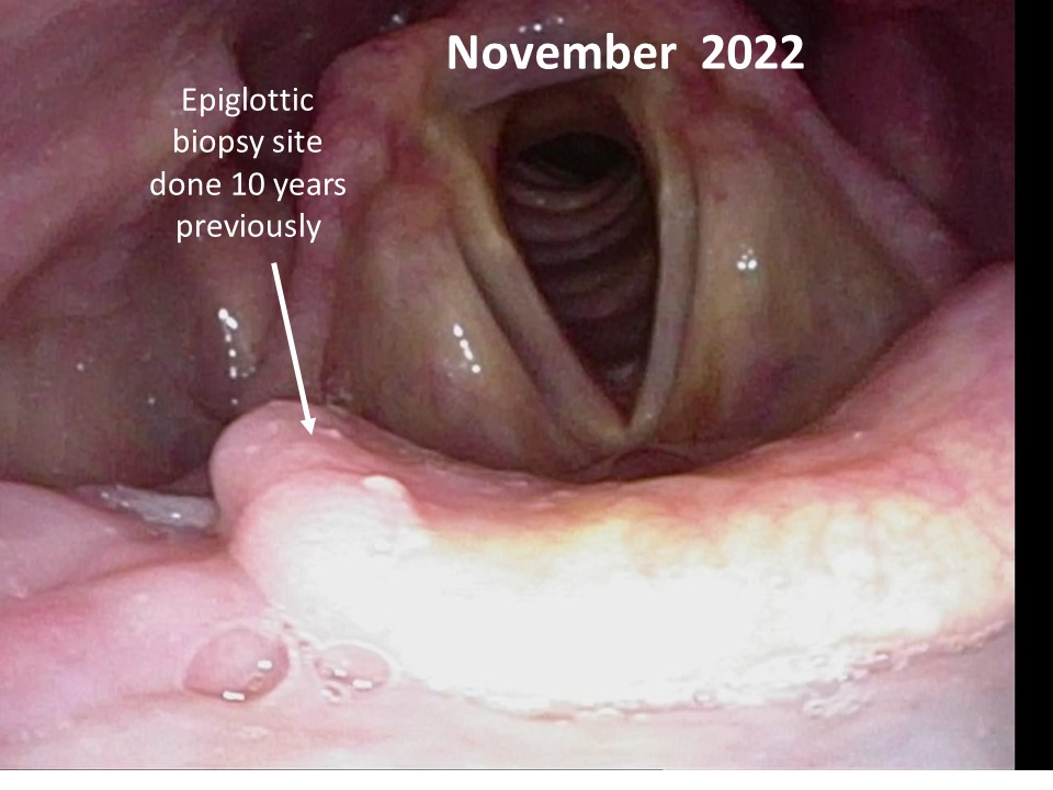 Pemphigus Vulgaris of the Larynx, Pharynx, and Oral Cavity | Iowa Head ...
