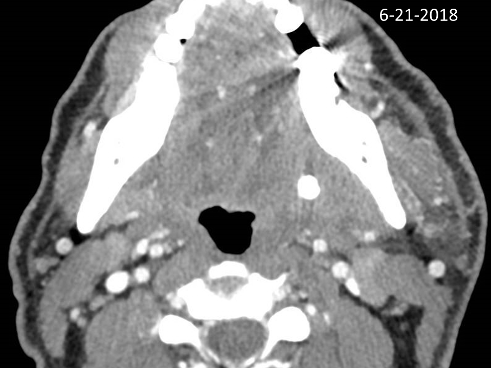 Submandibular Abscess from Stone | Iowa Head and Neck Protocols ...