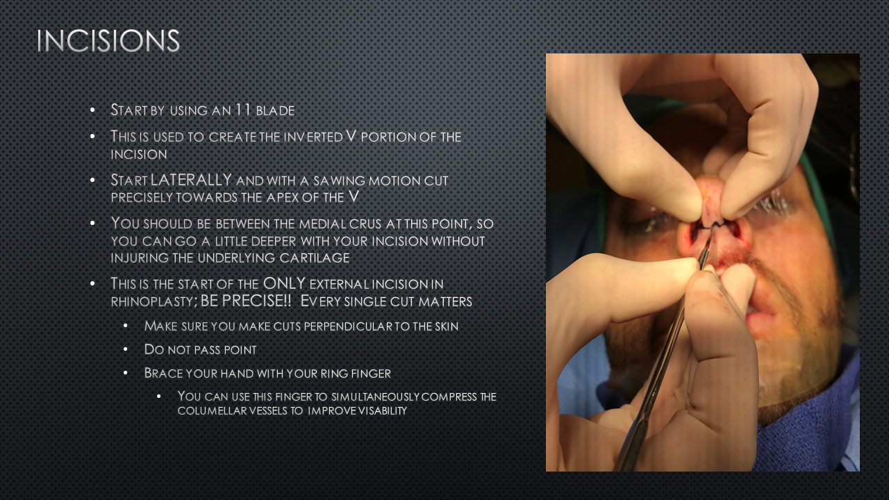 Open Septorhinoplasty - Surgical Demonstration (Rhinoplasty) | Iowa ...