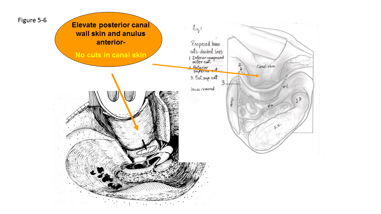 Canal Wall Reconstruction (Mastoidectomy) | Iowa Head and Neck ...