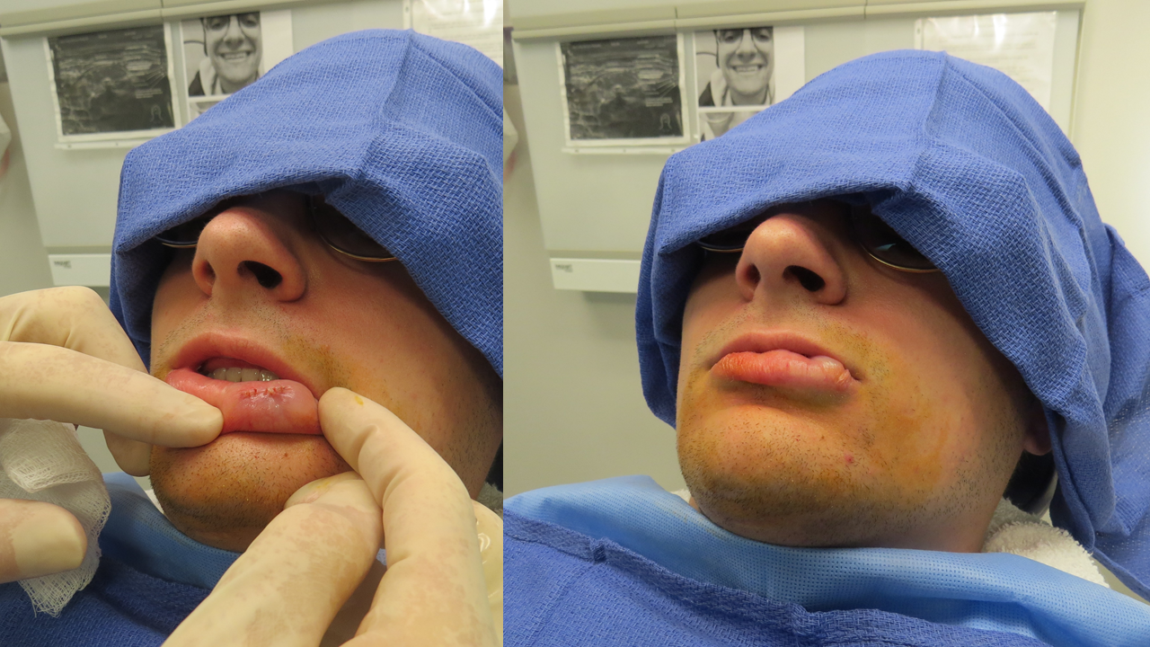 Lower Lip Bump (Mucocele versus Mucus Retention Cyst) Minor Salivary ...