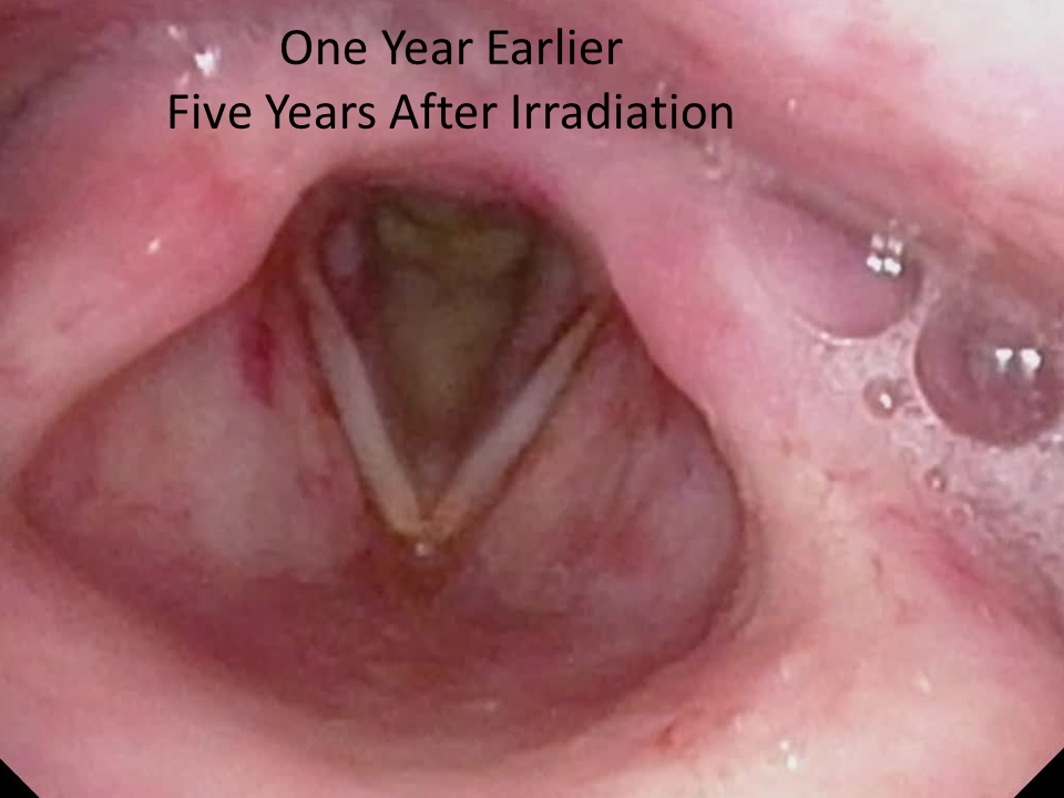 Vocal Fold Hemorrhage, Vocal Cord Bleed, Vocal Varix, Telangiectasia ...