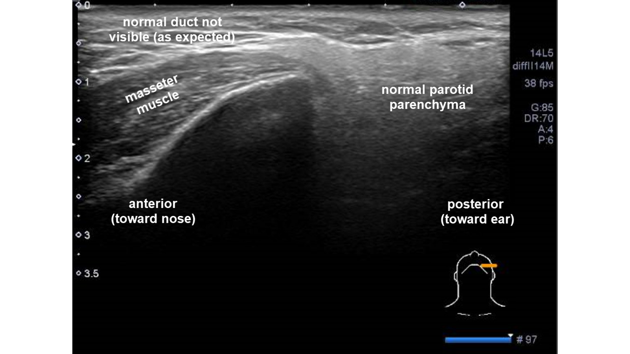 Salivary Ultrasound Complements Sialography | Iowa Head and Neck ...