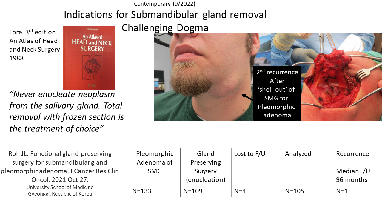 Submandibular Gland Resection/Excision | Iowa Head and Neck Protocols ...