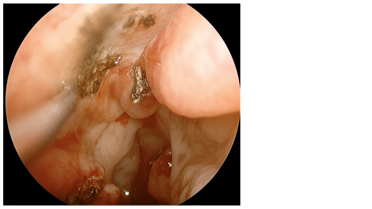 Nosebleed - Epistaxis: Sphenopalatine Artery (SPA) Ligation ...
