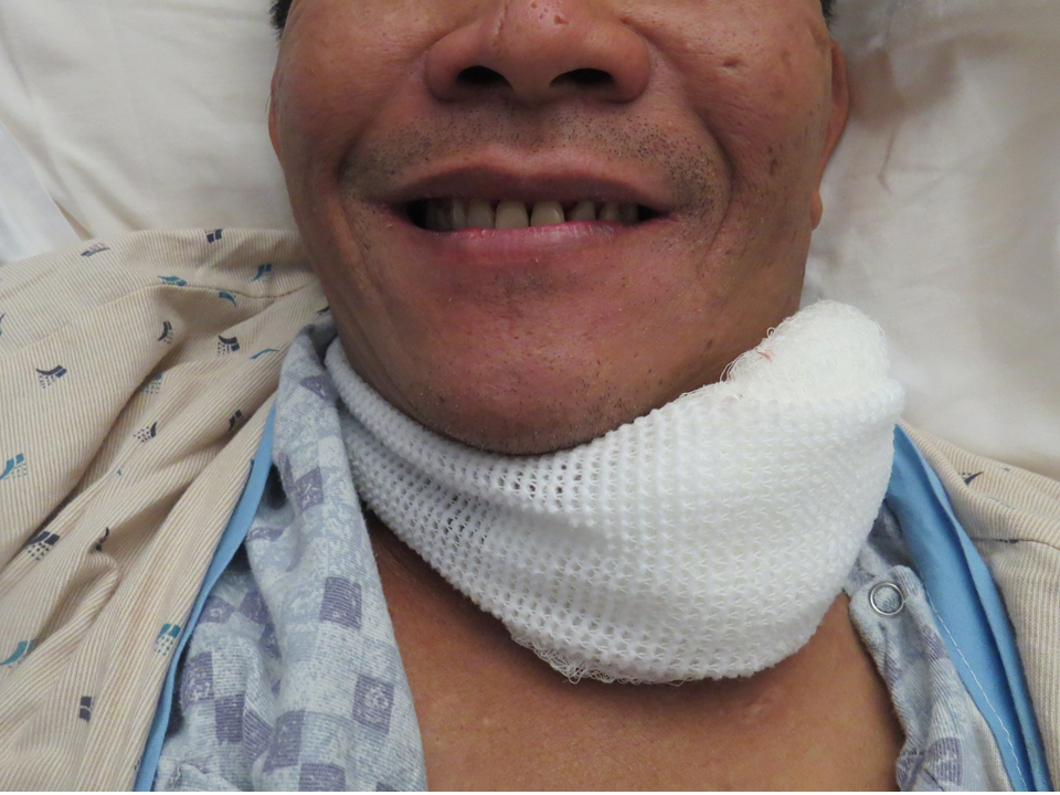 Submandibular Abscess from Stone | Iowa Head and Neck Protocols ...