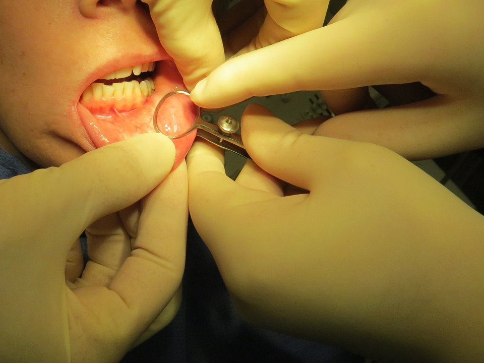 Lip Biopsy for Sjogren's Syndrome (Minor Salivary Gland Biopsy) Using ...