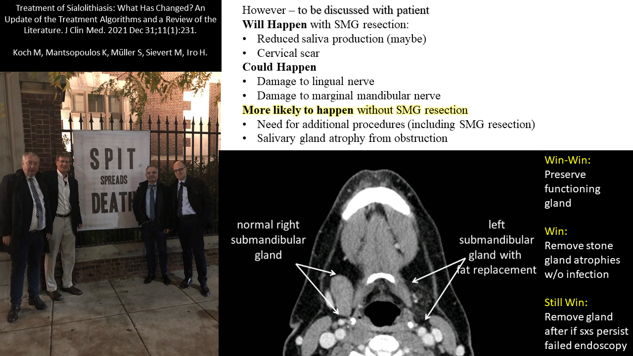 Submandibular Gland Resection/Excision | Iowa Head and Neck Protocols ...