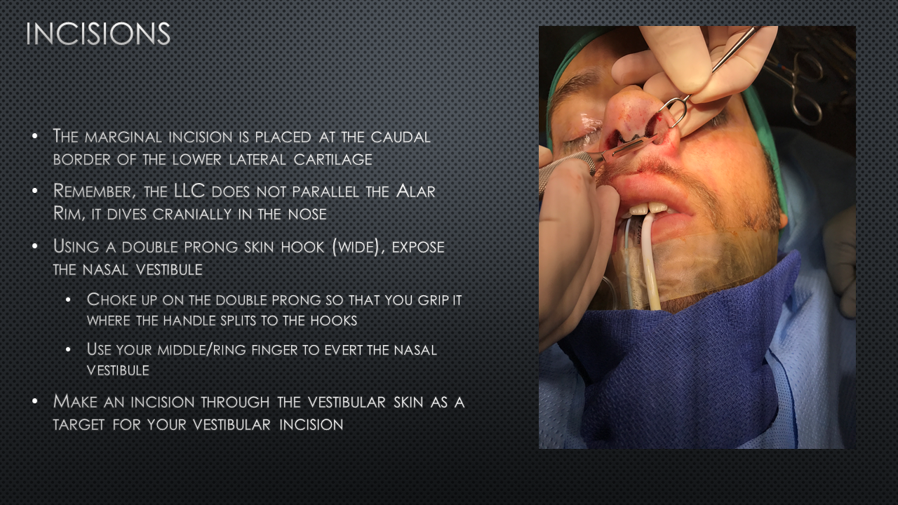 Open Septorhinoplasty - Surgical Demonstration (Rhinoplasty) | Iowa ...