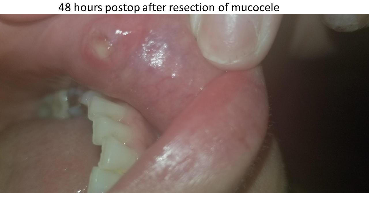 Complication From Lip Biopsy for Sjogrens with Mucocele Formation ...