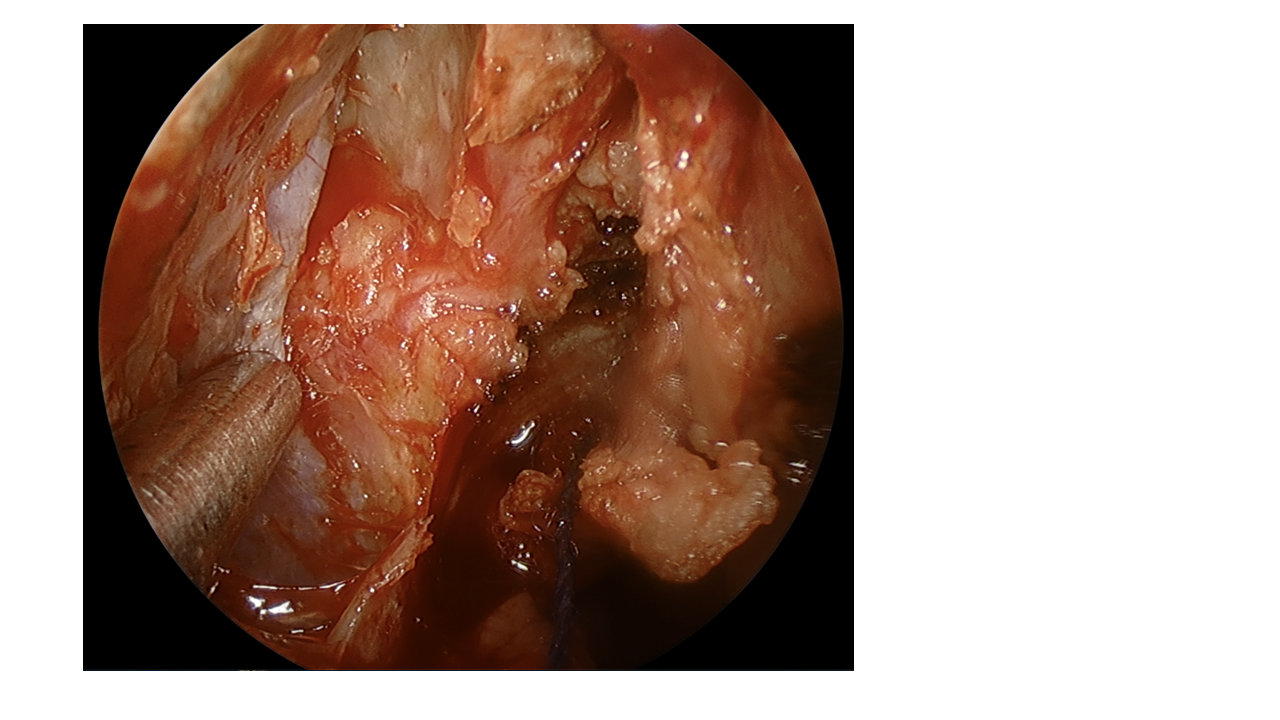 Nosebleed - Epistaxis: Sphenopalatine Artery (SPA) Ligation ...