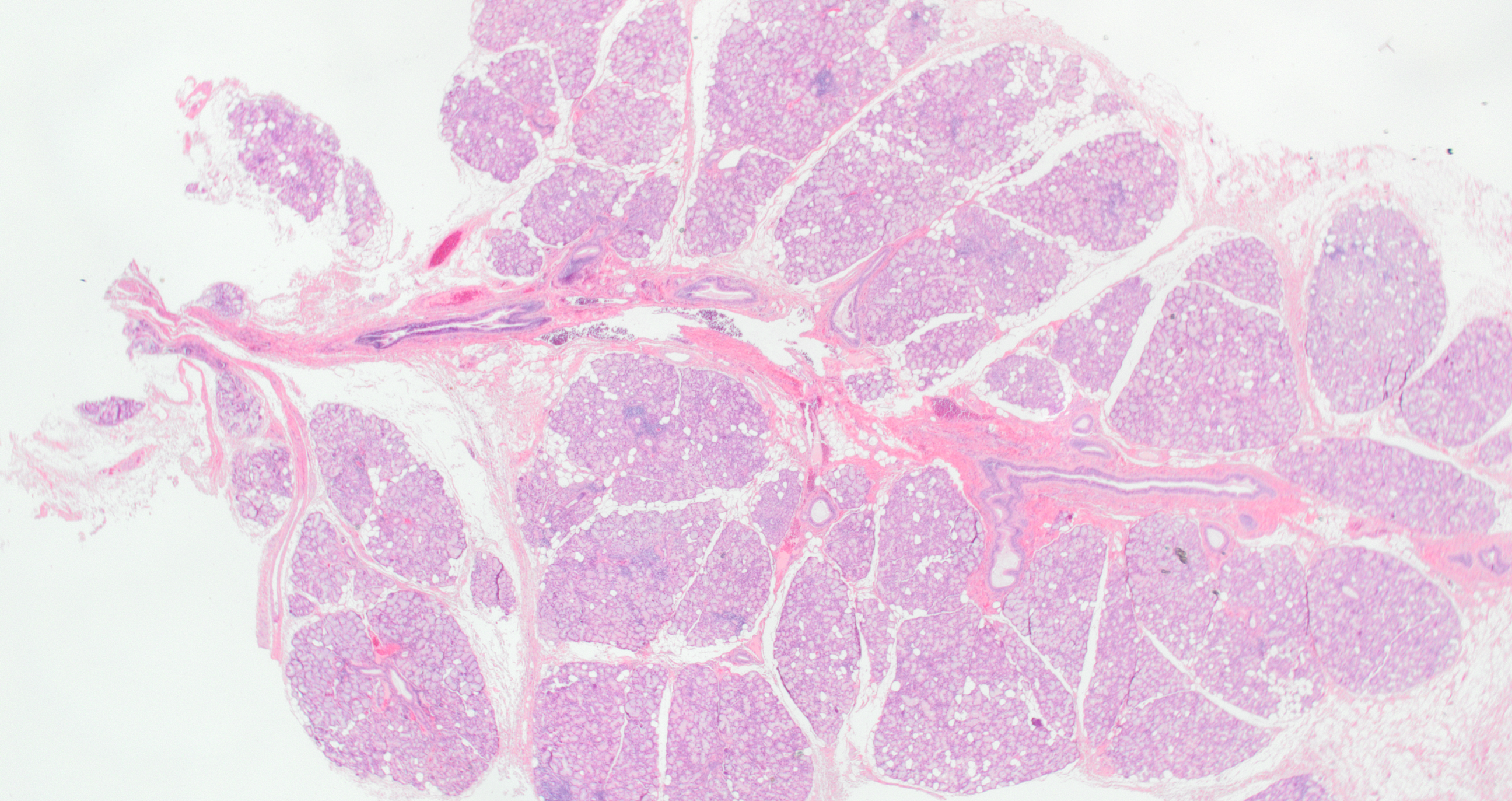Submandibular Gland Anatomy: The Uncinate Process of the Deep Lobe ...