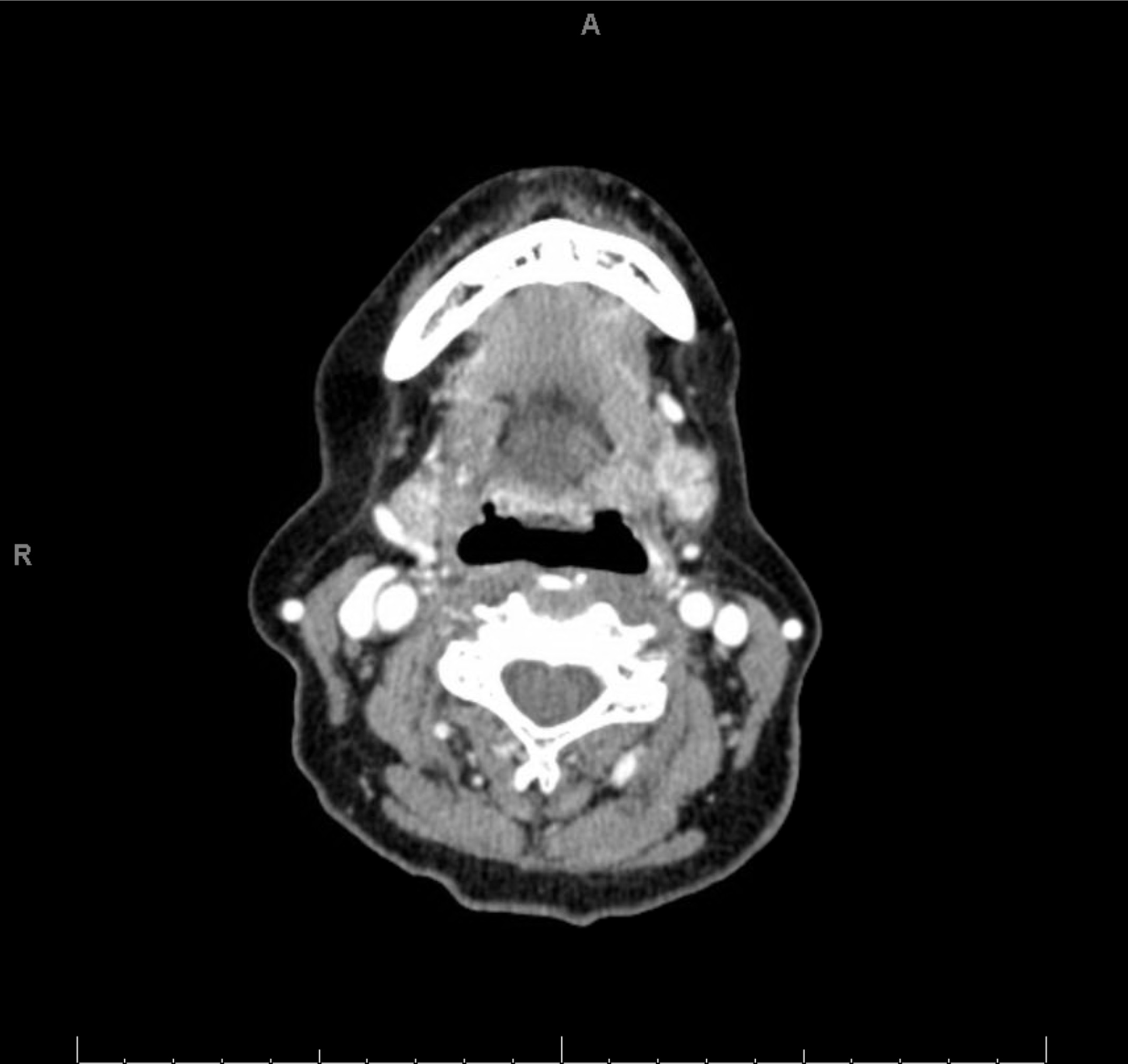 Chronic Submandibular Gland Sialadenitis - Case Example | Iowa Head and ...