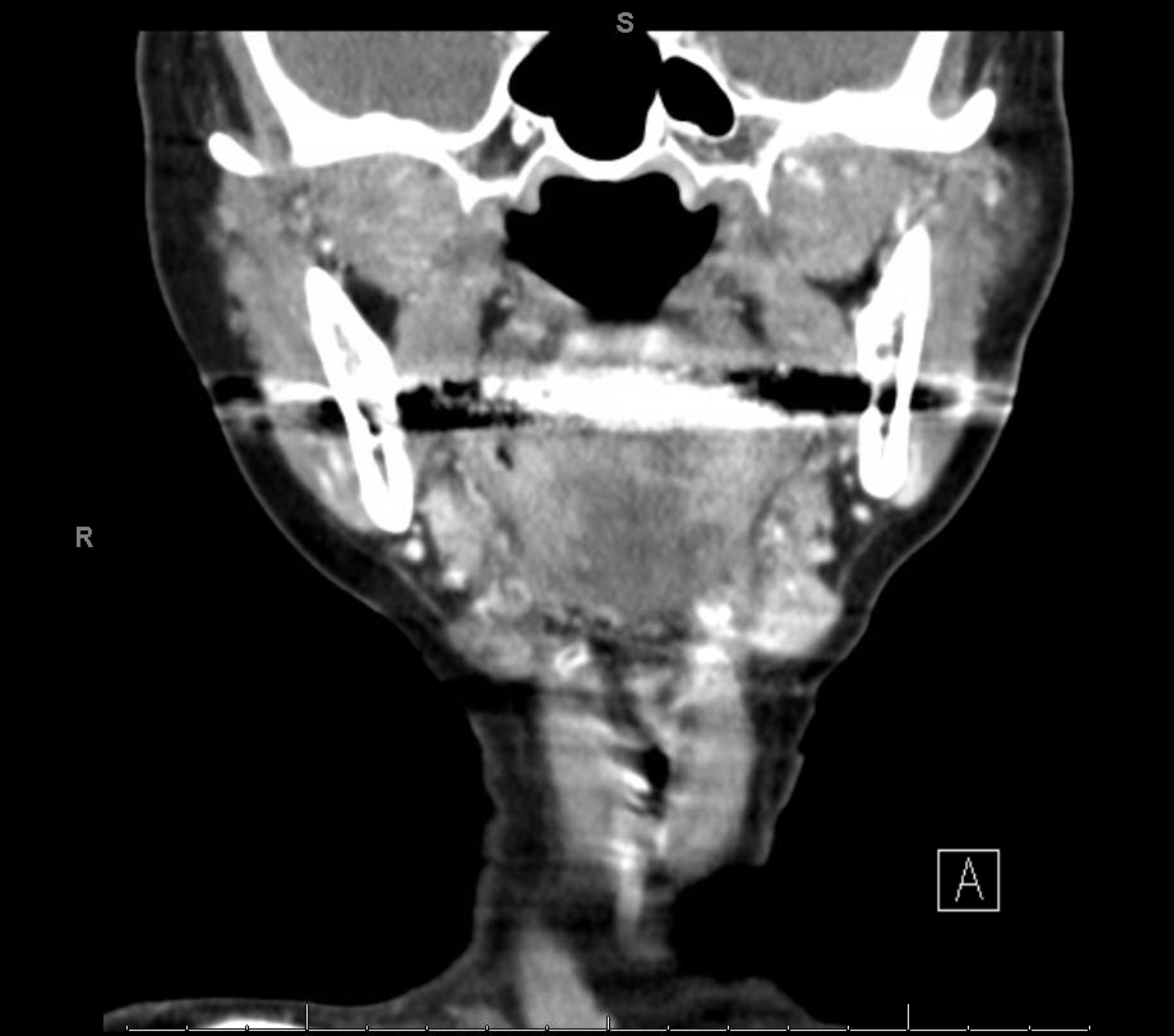 Chronic Submandibular Gland Sialadenitis - Case Example | Iowa Head and ...