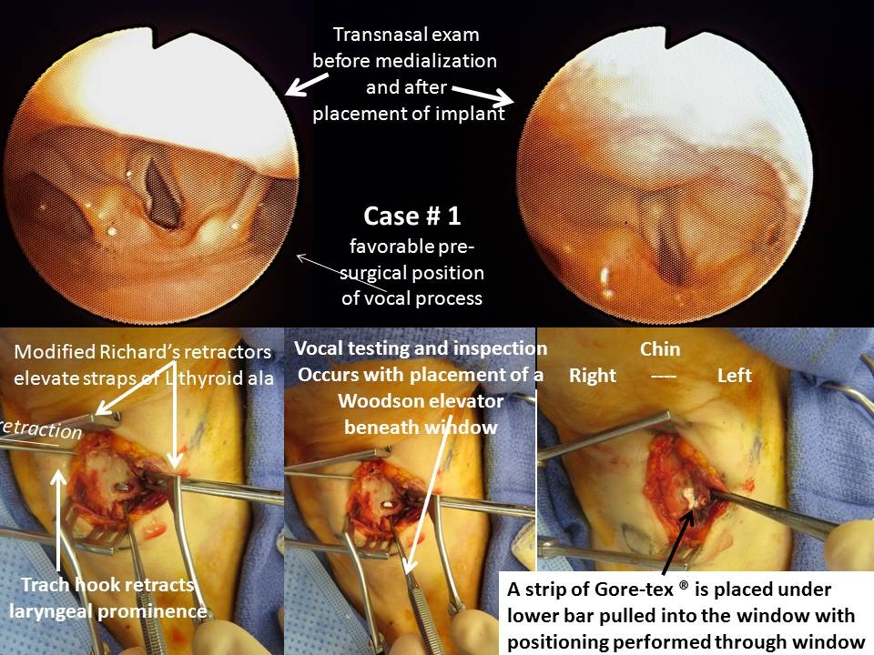 Type I Thyroplasty (Gore-Tex) Case Examples | Iowa Head and Neck ...