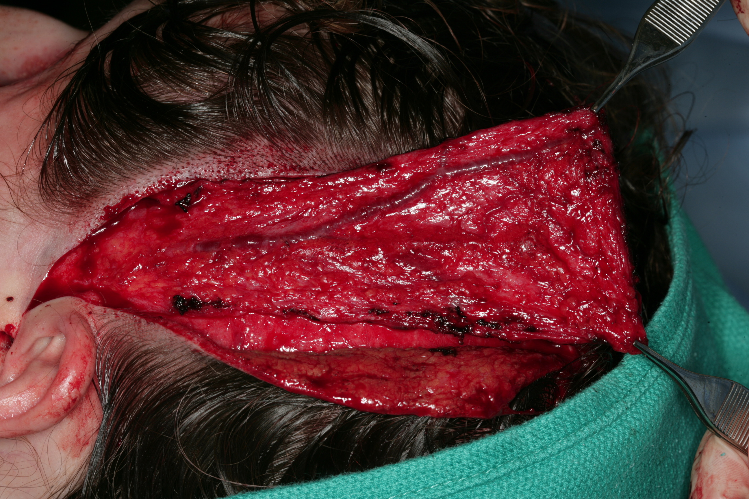 Temporoparietal Fascia Flap | Iowa Head and Neck Protocols - Carver ...