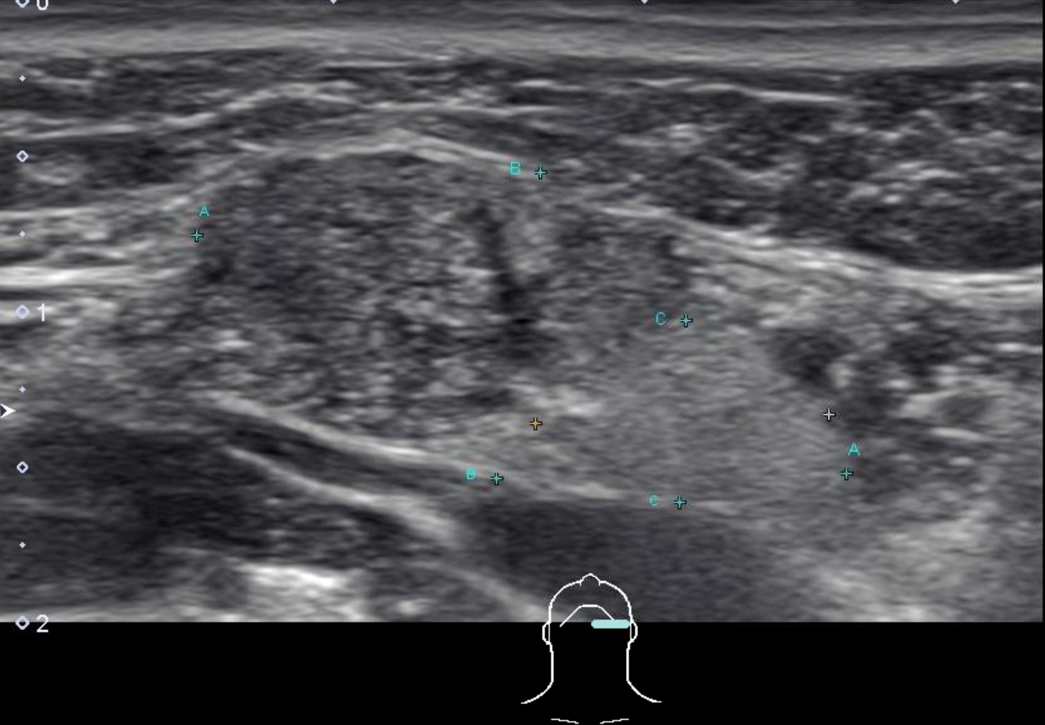 Chronic Submandibular Gland Sialadenitis - Case Example | Iowa Head and ...