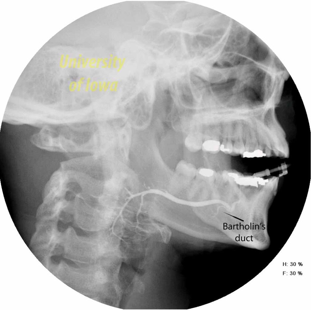Bartholin's Duct Anatomy | Iowa Head and Neck Protocols - Carver ...