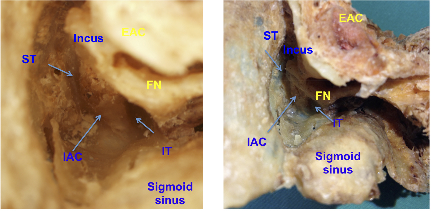 Temporal Bone Anatomy (Cadaveric Dissection) | Iowa Head and Neck ...