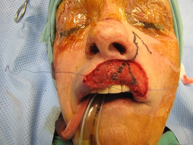 Lip Reconstruction Peri-alar Crescentic Advancement Flap - Clinical ...
