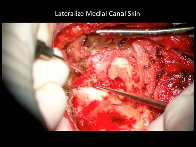 Subtotal Petrosectomy | Iowa Head and Neck Protocols - Carver College ...