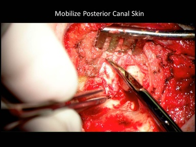 Subtotal Petrosectomy | Iowa Head and Neck Protocols - Carver College ...