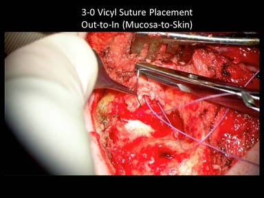 Subtotal Petrosectomy | Iowa Head and Neck Protocols - Carver College ...