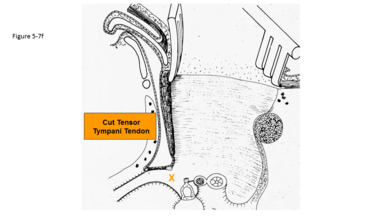Canal Wall Reconstruction (Mastoidectomy) | Iowa Head and Neck ...