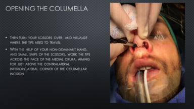 Open Septorhinoplasty - Surgical Demonstration (Rhinoplasty) | Iowa ...