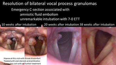 Intubation Granuloma | Iowa Head and Neck Protocols - Carver College of ...