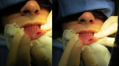 Lower Lip Bump (Mucocele versus Mucus Retention Cyst) Minor Salivary ...